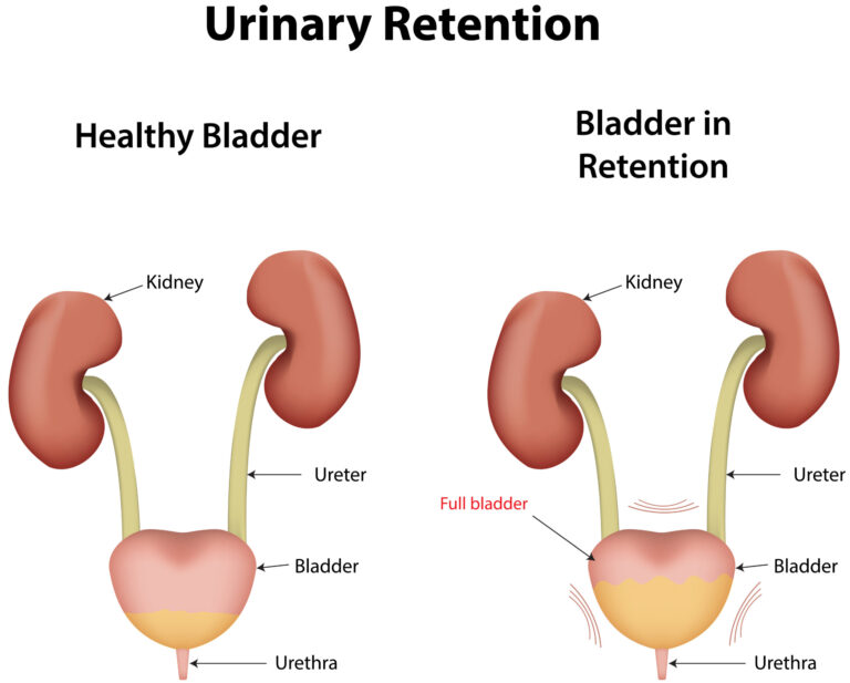 Urinary Retention
