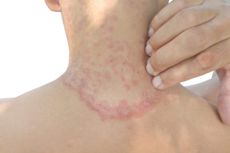 Ringworm: 7 Common Types Of Ringworm And Their Symptoms Explained