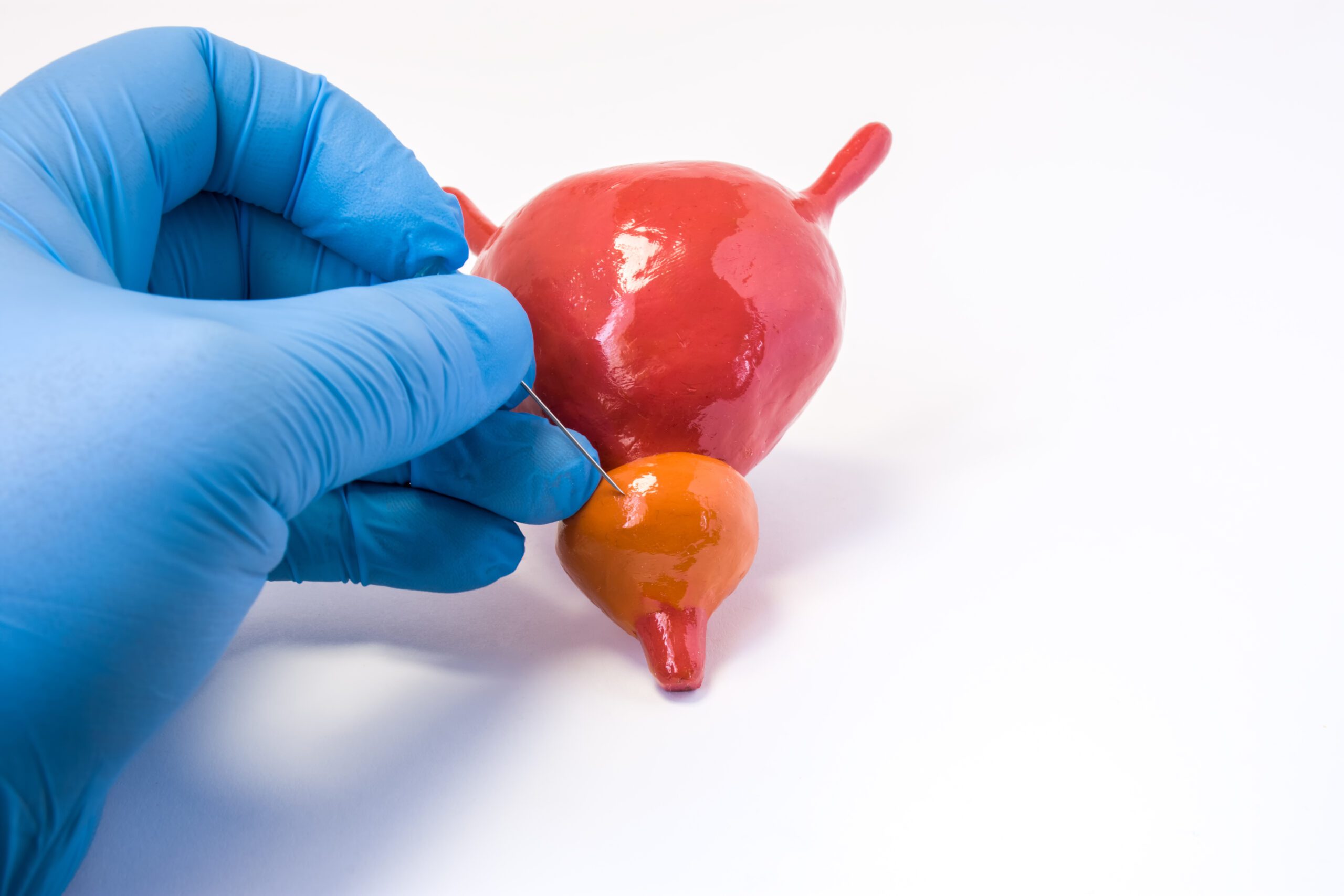 Prostate Biopsy Procedure: Step-by-Step Guide And Patient Considerations