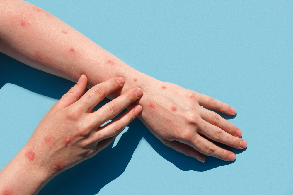 The Rise Of Mpox: Understanding The Symptoms, Transmission, And ...