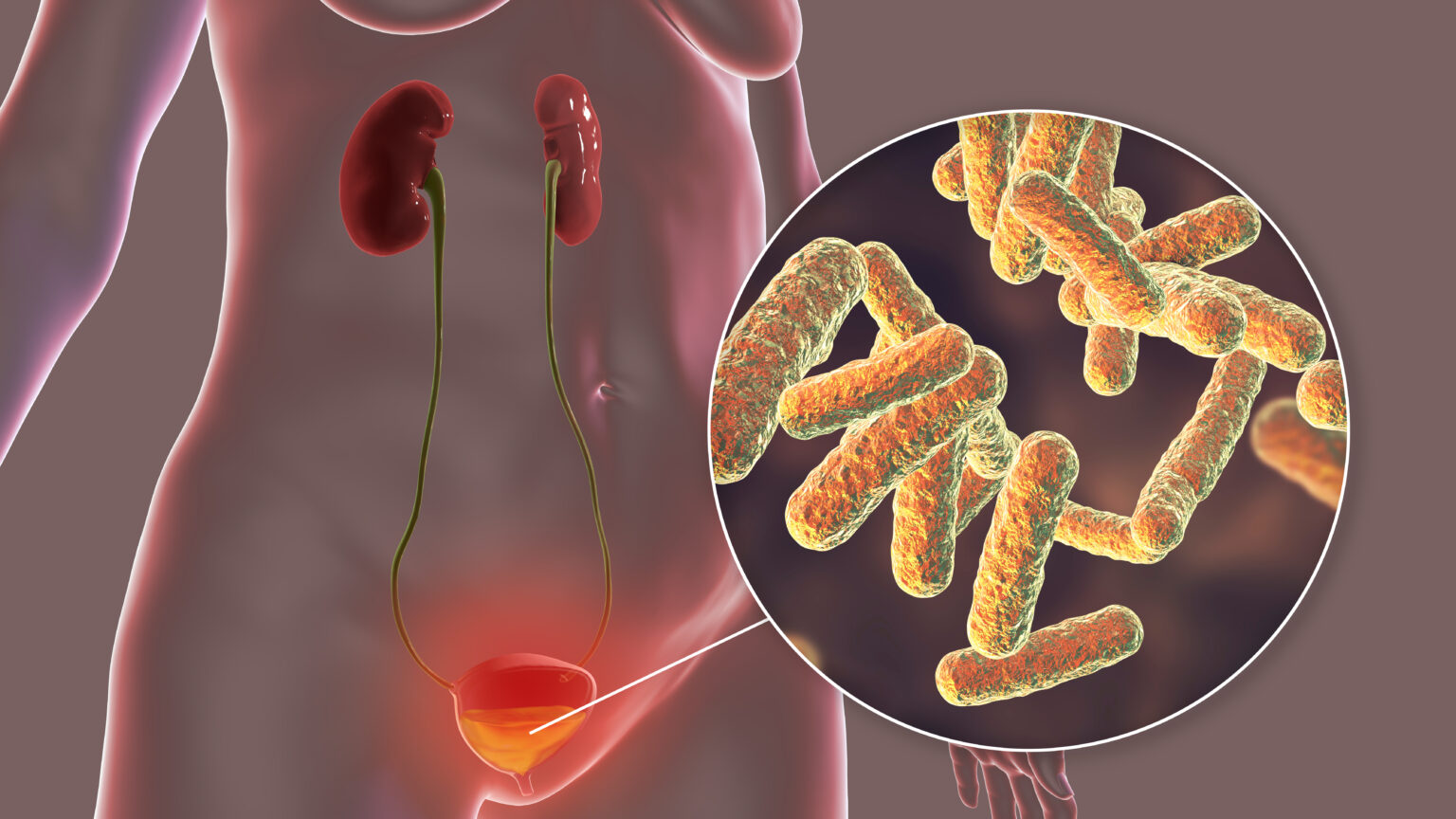 Understanding Bacteria In Urine: Causes And Treatments
