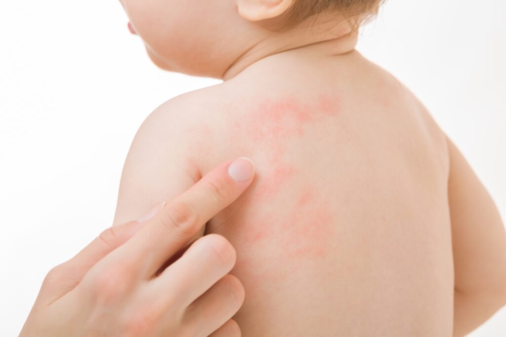 Hives And Skin Allergies: Causes, Symptoms, And How To Manage Them