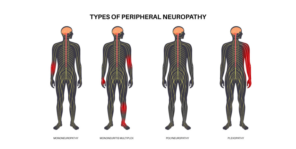 Understanding Neuropathic Pain: Causes And Treatments