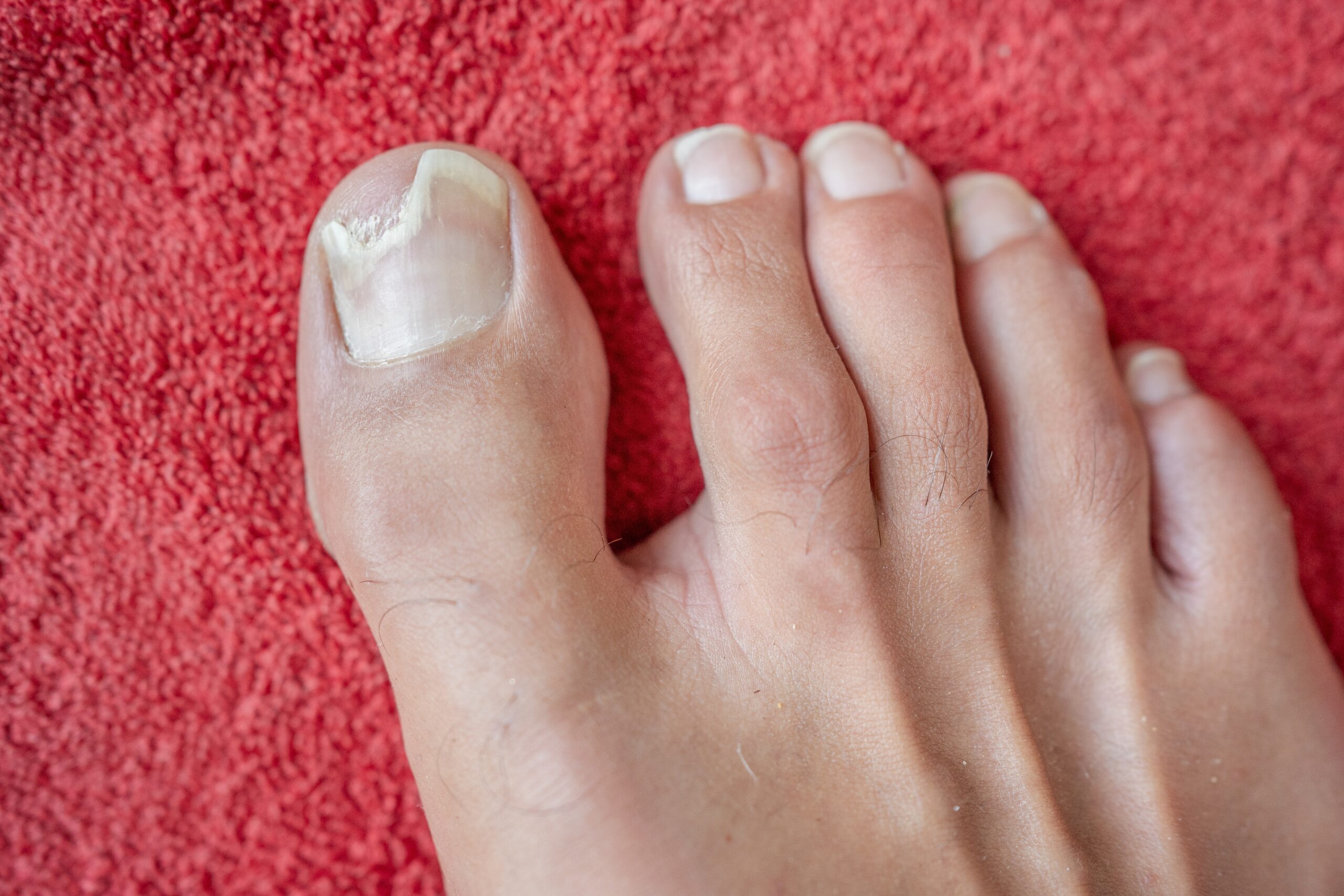 Nail Disorders: When To See A Dermatologist Vs. Podiatrist