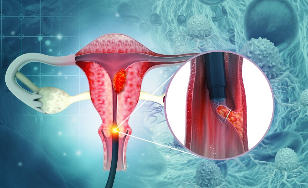 Endometrial Biopsy - Doral Health & Wellness NY