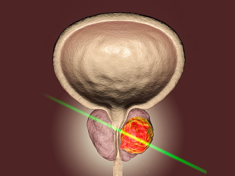 GreenLight Laser Therapy - Doral Health & Wellness NY