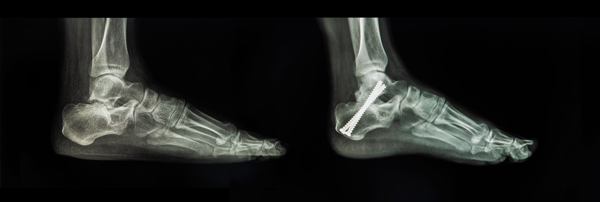 Foot Bone Fusion Surgery: Complex Deformity Correction Techniques