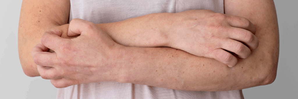Hives And Angioedema: Causes, Treatment, And When To Worry
