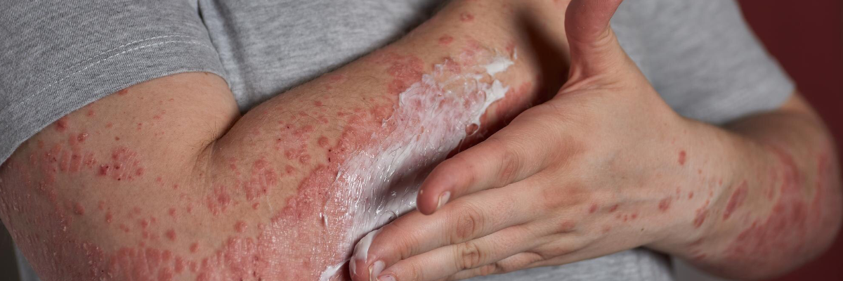 Psoriasis Treatments: Topicals, Biologics, And Lifestyle Tips