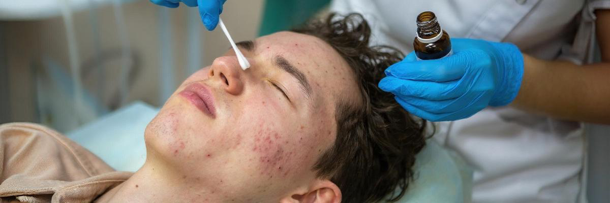 Acne Treatment Beyond Topicals: When To Consider Professional Procedures