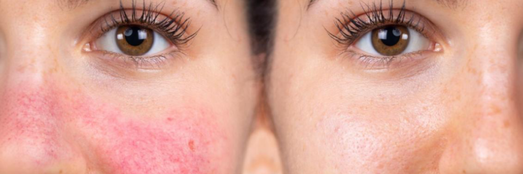Rosacea Vs. Acne: Identifying Your Facial Redness And Choosing Treatment