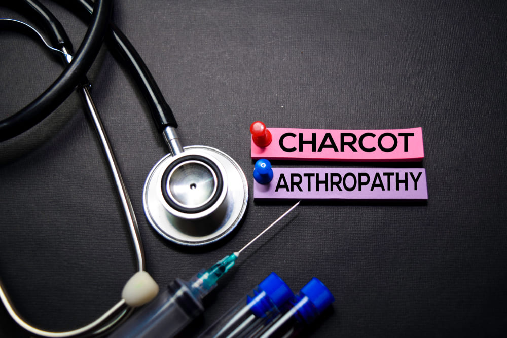 Charcot Foot: The Silent Joint Collapse That Threatens Your Feet