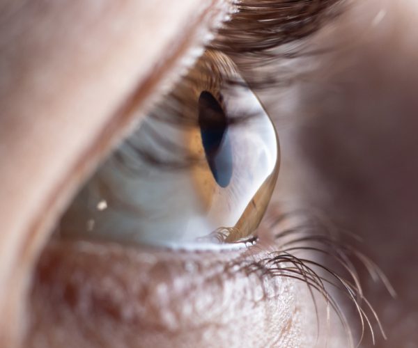 Corneal Transplant (Keratoplasty) - Doral Health & Wellness NY