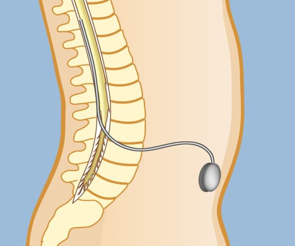 Intrathecal Drug Delivery (Pain Pumps) - Doral Health & Wellness NY